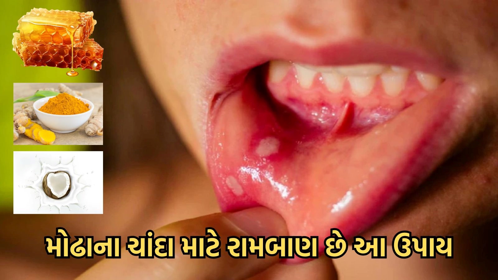 મોઢામાં પડેલા ચાંદા મટાડવાની ઘરેલુ રીત | Best Natural and Home Remedies ...